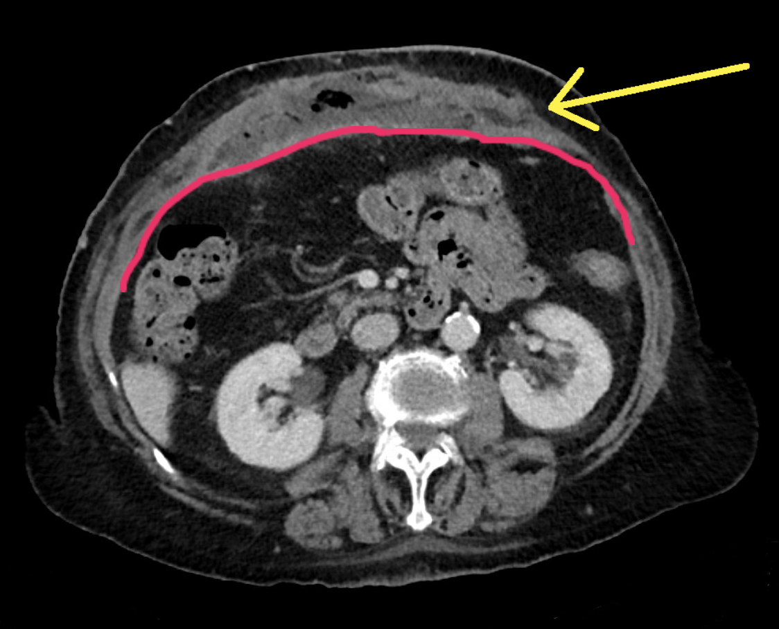 Management of Chronic Mesh Infection with Negative Pressure Wound ...